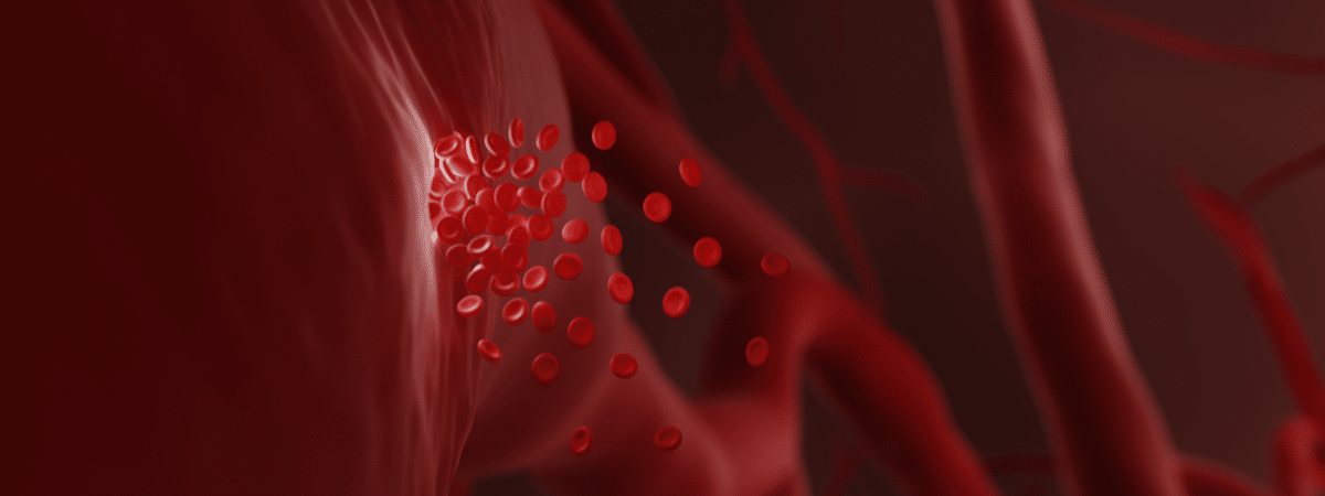 Internal Bleeding: a Deadly Injury That Often Remains Hidden - Rocky ...